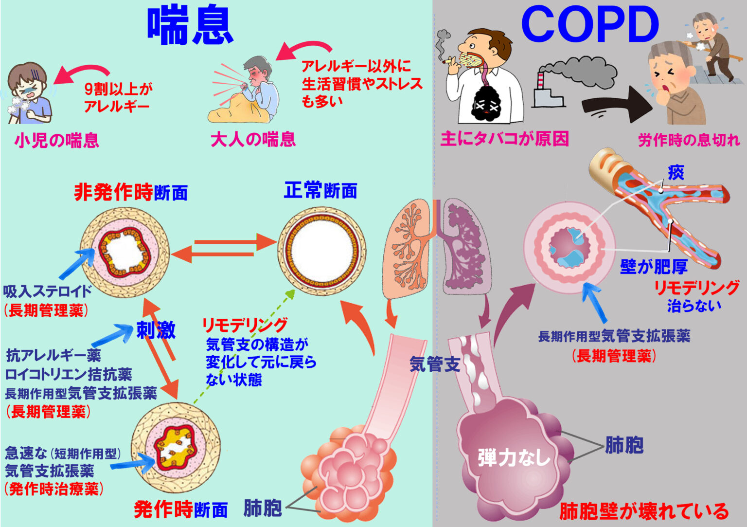 今さら聞けない!「喘息」と「copd慢性閉塞性肺疾患)」の違い 絵とゴロで楽しく覚えるクスリの名前